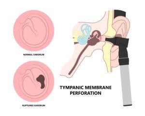 Ear Drum Perforation Treatment in Savannah and Pooler, GA